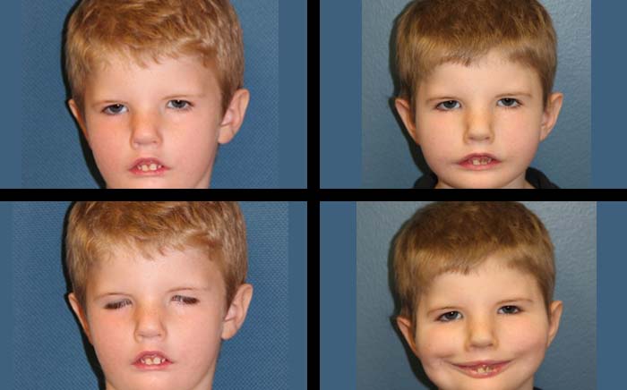 Facial Paralysis Gallery | St. Louis Children's Hospital