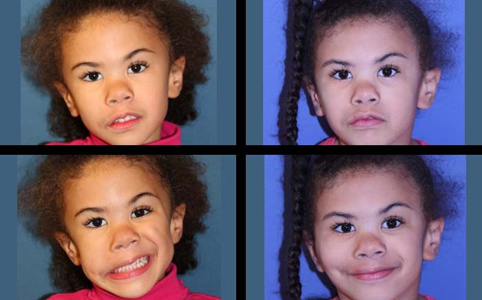Facial Paralysis Gallery | St. Louis Children's Hospital