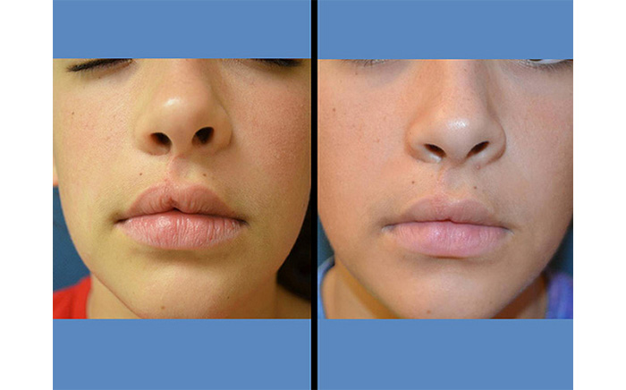 Cleft Lip Revision Gallery | St. Louis Children's Hospital