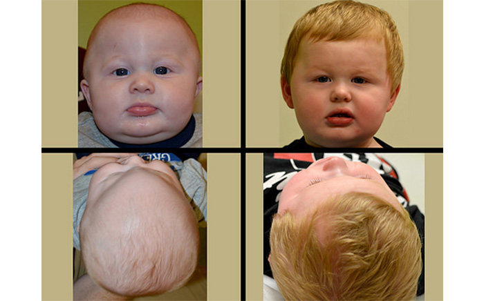 Open Craniosynostosis Repair Gallery | St. Louis Children's Hospital